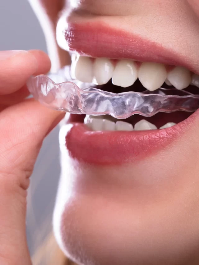 ClearCorrect Aligners for Teeth - Dr. Vikram's Align